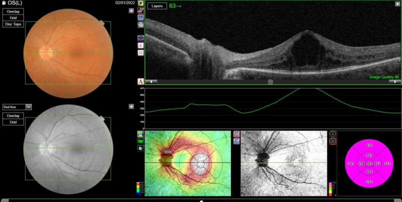 Imperfect Fusion in Low Vision – Why Eye Teaming Matters – Low Vision ...